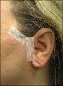 Minimal Incision Facelift - Minimal Incision Surgery
