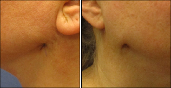 Lower Facelift and Neck Lift | Neck Lift Surgery Service | Chicago ...