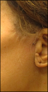 Minimal Incision Facelift - Minimal Incision Surgery