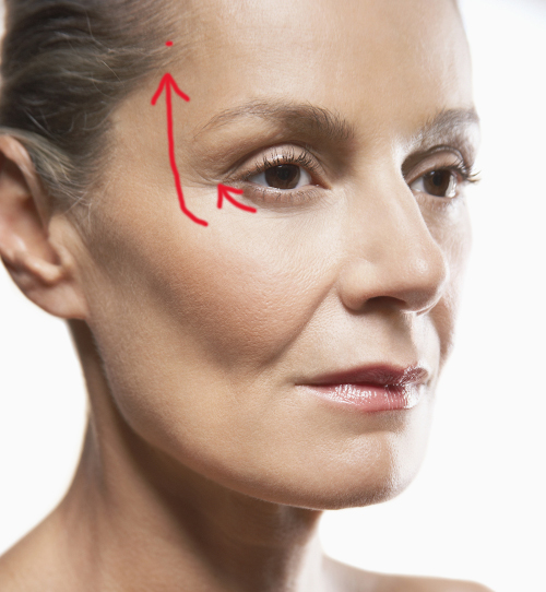 Minimal Incision Facelift - Minimal Incision Surgery