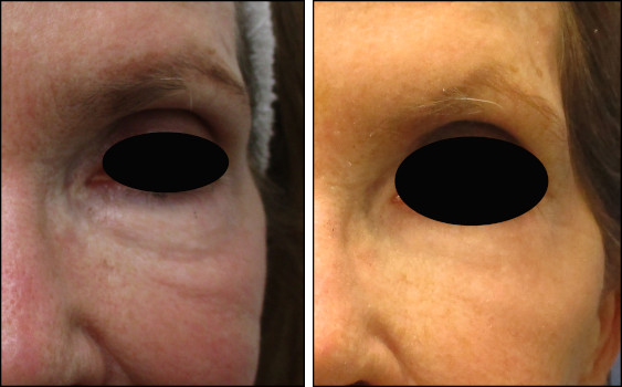 Minimal Incision Facelift - Minimal Incision Surgery