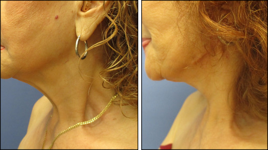 Minimal Incision Facelift - Minimal Incision Surgery