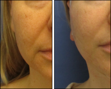 Minimal Incision Facelift - Minimal Incision Surgery