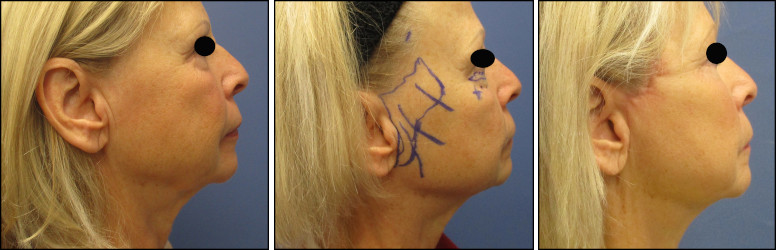 Minimal Incision Facelift - Minimal Incision Surgery