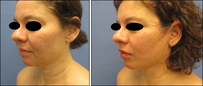 Minimal Incision Facelift - Minimal Incision Surgery