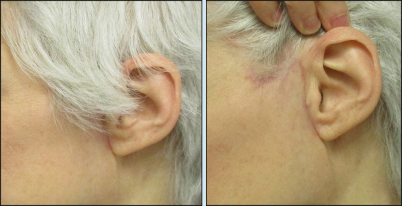 Minimal Incision Facelift - Minimal Incision Surgery