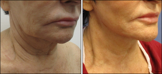 Minimal Incision Facelift - Minimal Incision Surgery