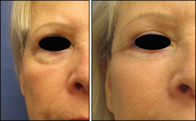 Minimal Incision Facelift - Minimal Incision Surgery