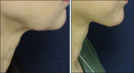 Minimal Incision Facelift - Minimal Incision Surgery