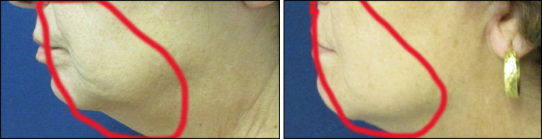 Minimal Incision Facelift - Minimal Incision Surgery