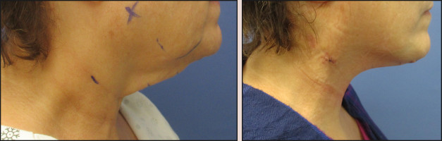 Lower Facelift and Neck Lift | Neck Lift Surgery Service | Chicago ...