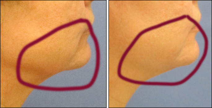 Minimal Incision Facelift - Minimal Incision Surgery