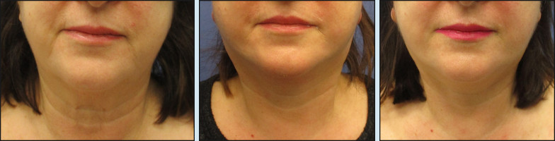 Minimal Incision Facelift - Minimal Incision Surgery