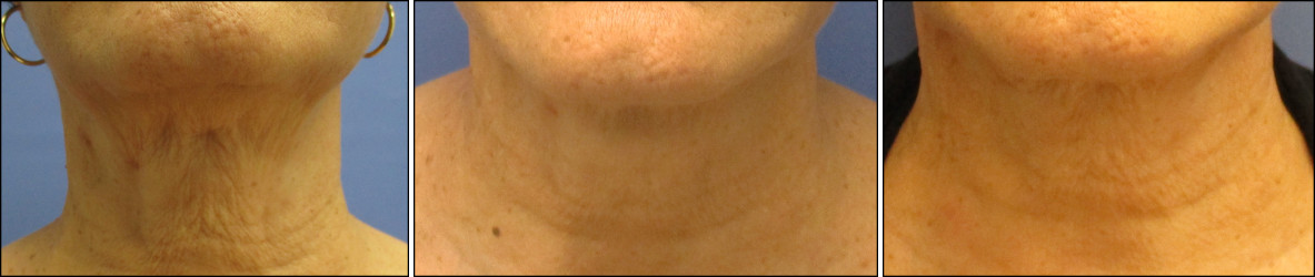 Minimal Incision Facelift - Minimal Incision Surgery